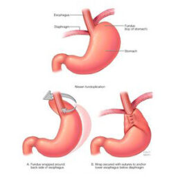 Laparoscopic Fundoplication | Oesophageal Acid Reflux Treatment Perth